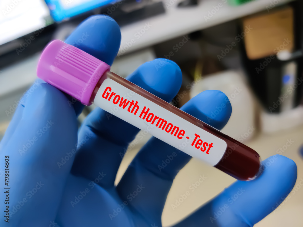 Blood sample for Growth Hormone (GH) test. To diagnosis hormonal ...