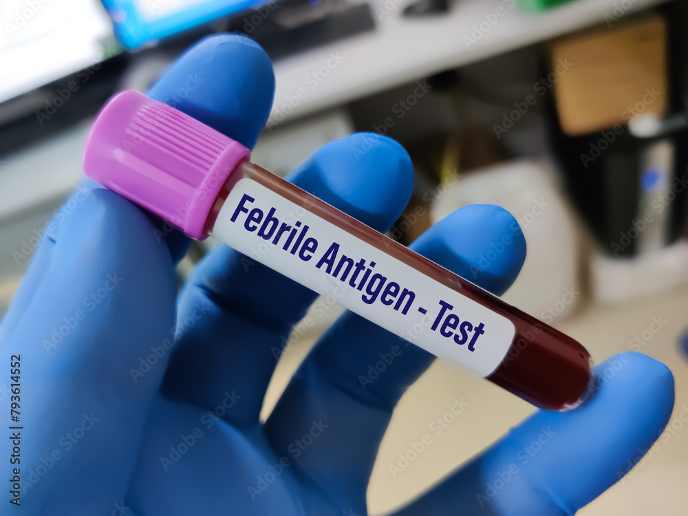 Blood sample for Febrile antigen test. To diagnosis hormonal imbalance ...