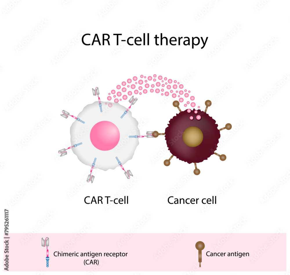 CAR T-cell therapy and Cancer treatment . Chimeric antigen receptor T ...