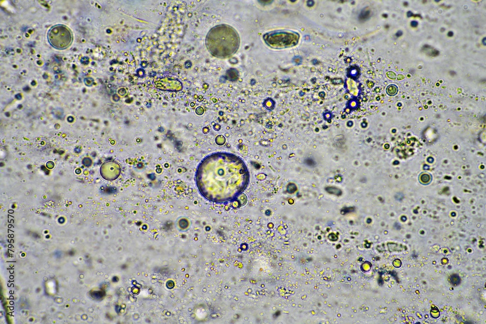 Coughing up mucus and phlegm from a chest infection from a virus and ...