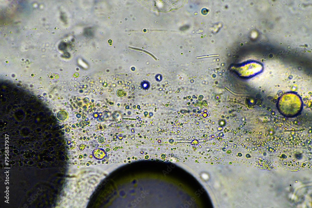 Coughing up mucus and phlegm from a chest infection from a virus and ...