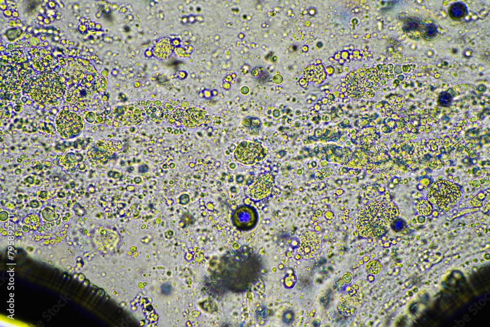 Coughing up mucus and phlegm from a chest infection from a virus and ...