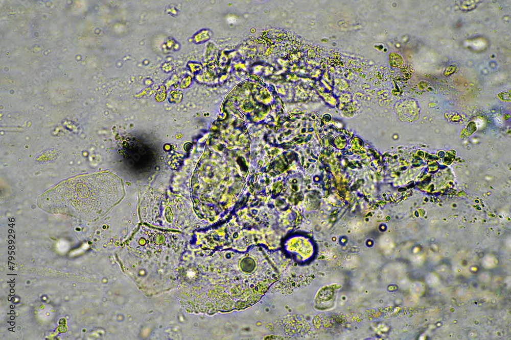 Coughing up mucus and phlegm from a chest infection from a virus and ...