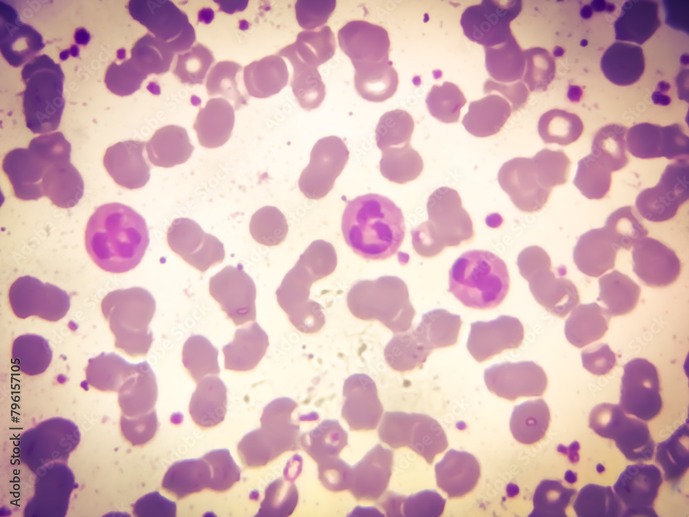 Giant platelets, Neutrophils and Red blood cells (RBC) analysed by ...