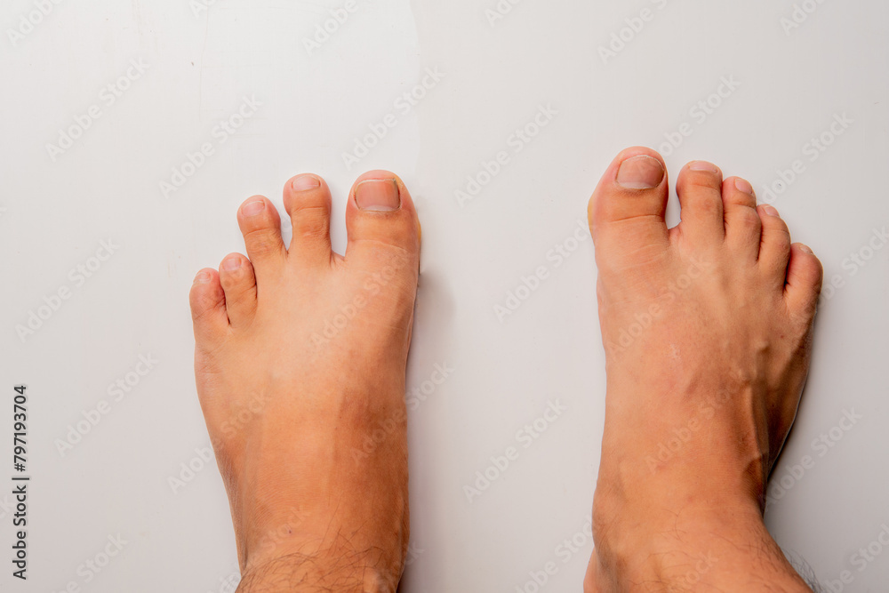 Male foot with shortest fourth toe. Brachymetatarsia Morton's foot ...