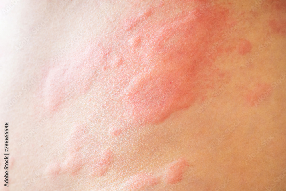 Skin allergy rash dermatitis texture close up background Stock Photo ...