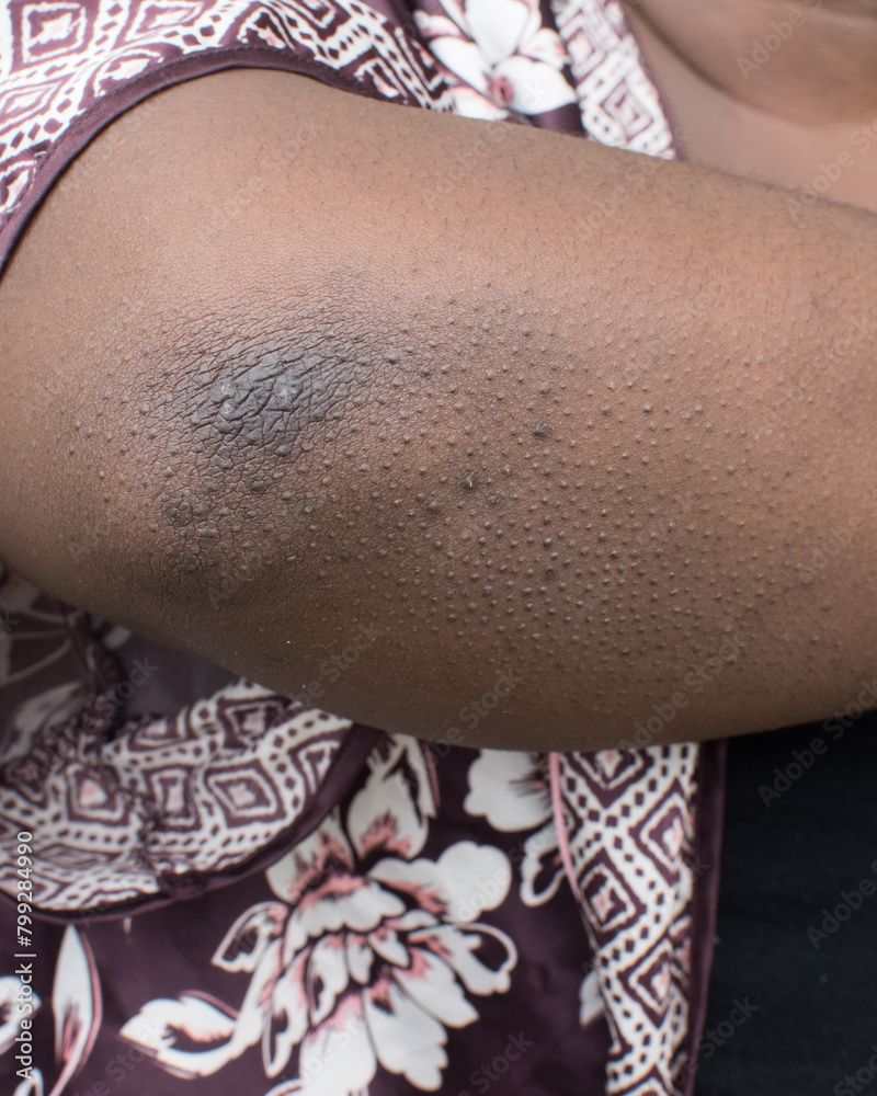 Elbows with dark spots and rashes, hyperpigmentation on brown skin ...