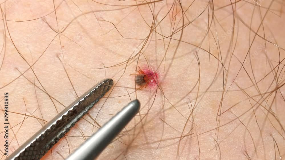 Vidéo Stock Close-up view of tick being removed from human skin with ...