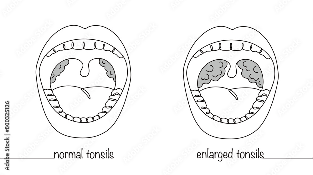Palatine tonsils Stock Vector | Adobe Stock