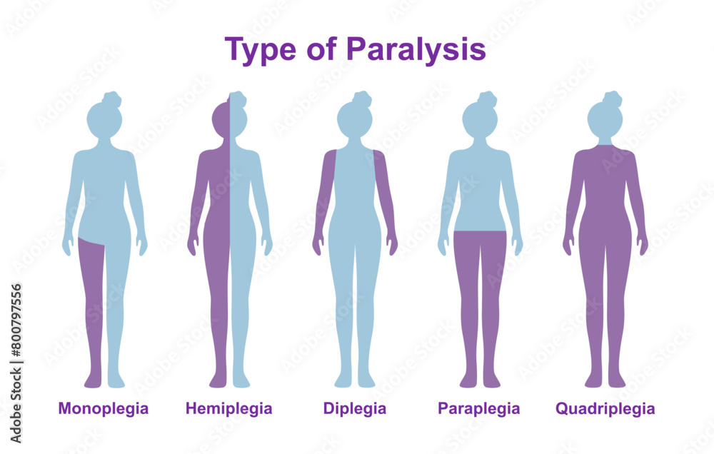 Paralysis types, spinal cord injury. Stroke, tumor, nerve damage brain ...