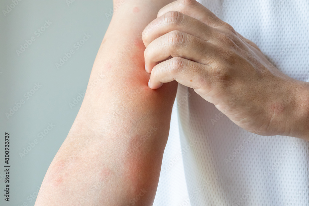 Young asian man itching and scratching on arm from allergic itchy dry ...