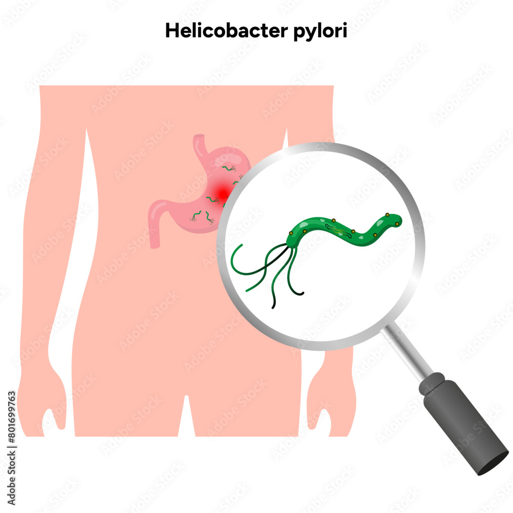 Helicobacter pylori Stock Vector | Adobe Stock