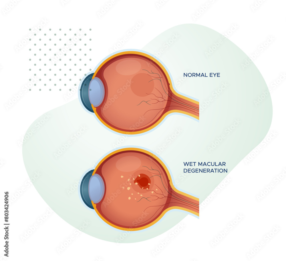 Poster Healthy Eyes vs Wet Macular Degeneration - Stock Illustration ...