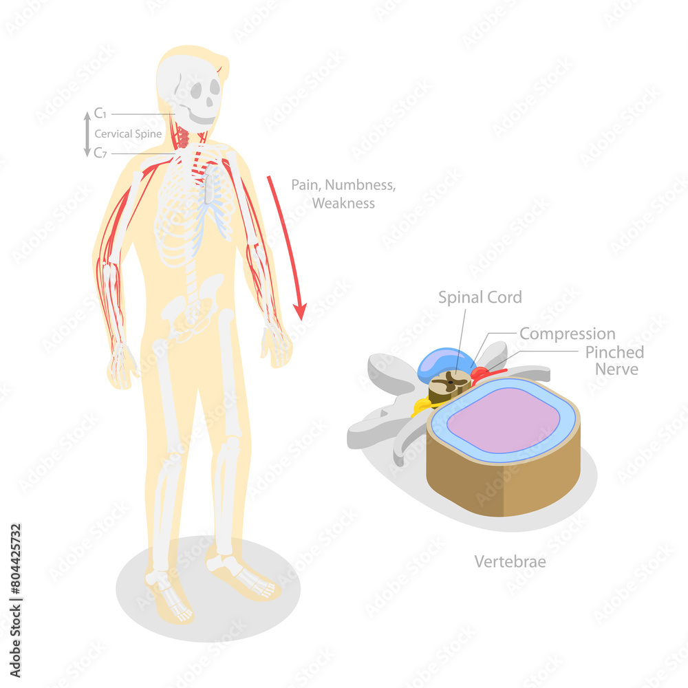 3D Isometric Flat Illustration of Cervical Radiulopathy, Traumatic ...
