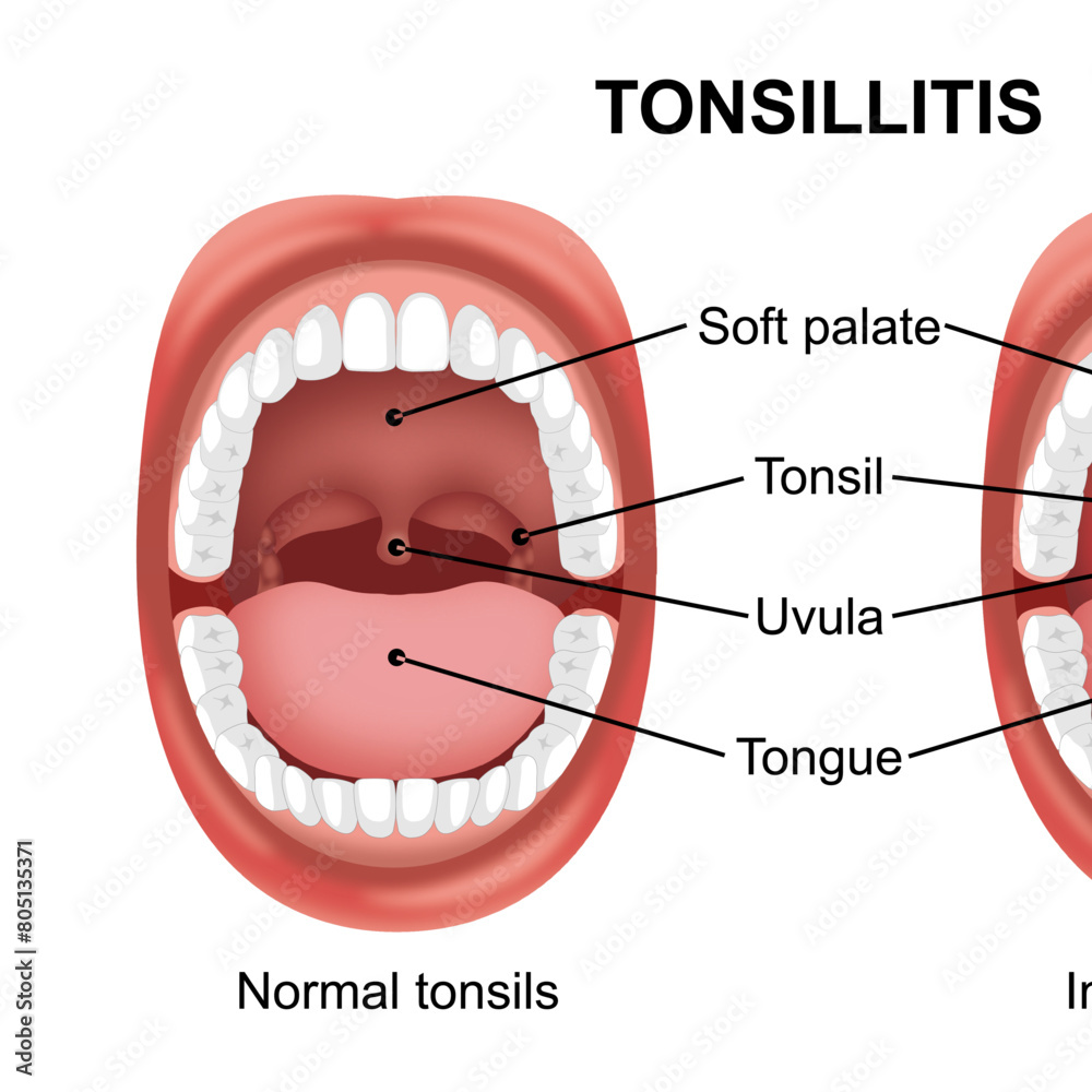Tonsillitis throat infection inflamed tonsil illustration Stock Vector ...