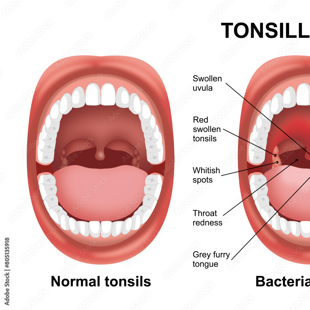 Tonsillectomy throat Viral and Bacterial infection inflamed tonsil ...