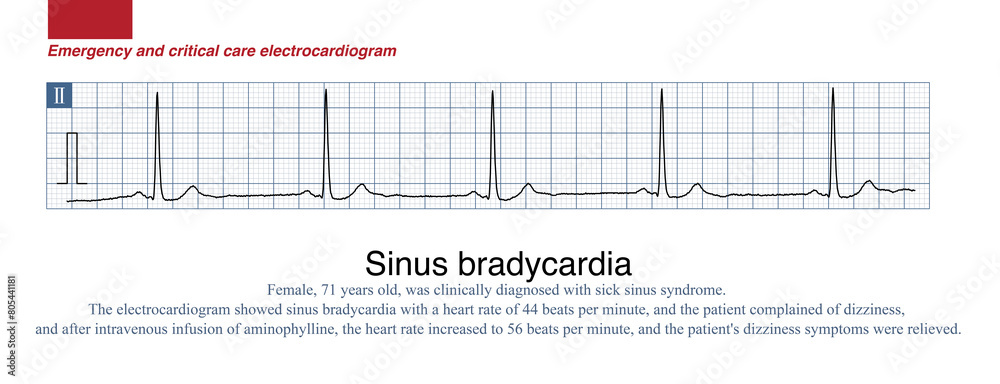 Sinus heart rate less than 60 beats per minute in adults is called ...