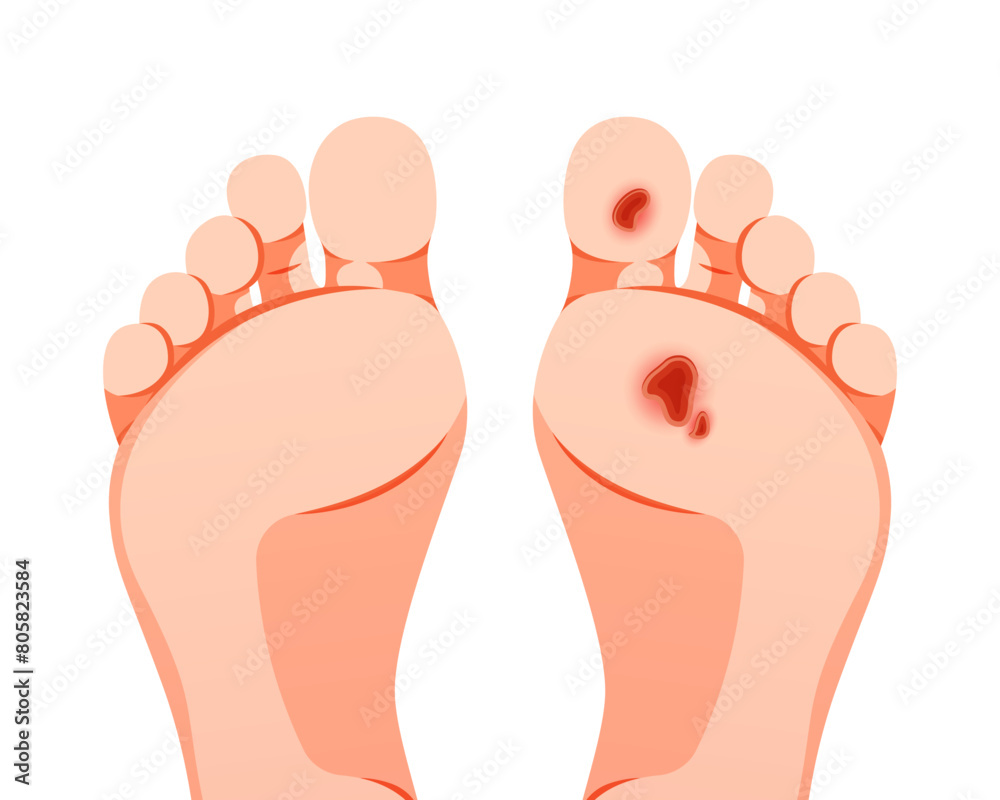 Diabetic foot ulcers vector isolated on white background. Stock Vector ...