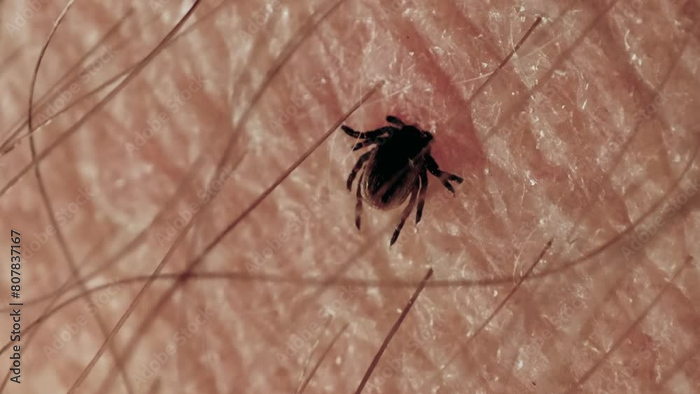 macro of a tick embedded in human skin dangerous insect bite with ...