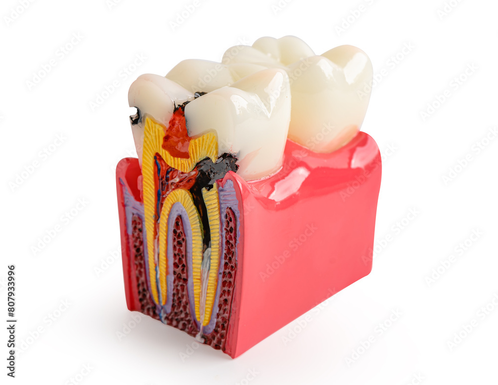 Tooth decay, Dental implant, artificial tooth roots into jaw, root ...