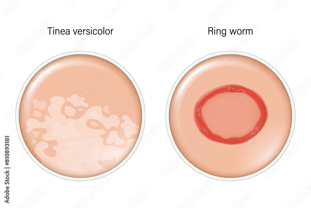 Comparison of Tinea versicolor and Ring worm. Dermatology ...