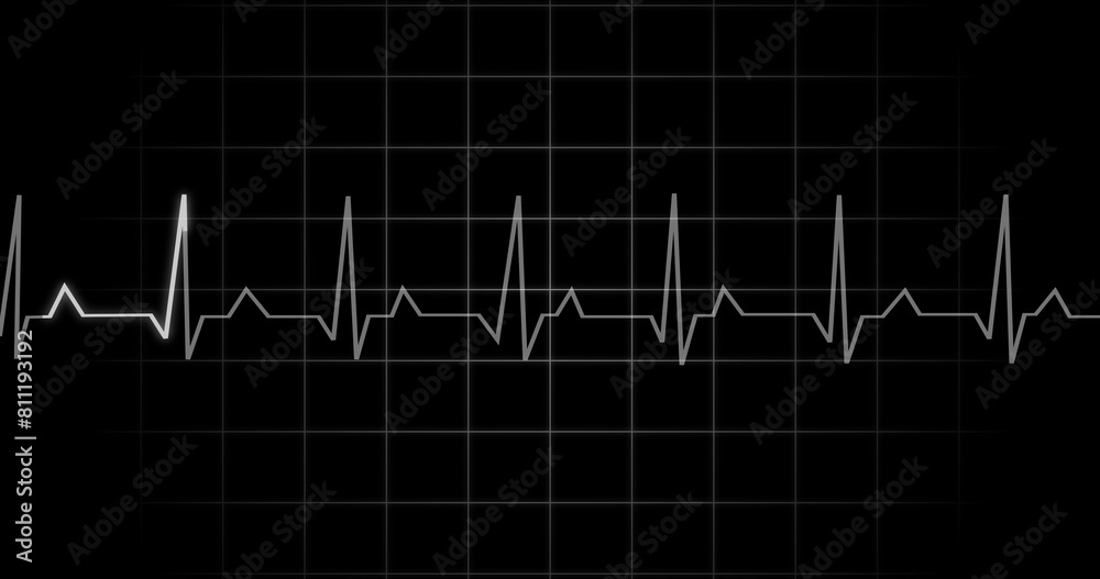 EKG Heartbeat reading animation on black background. Medical monitor ...