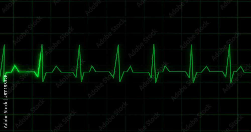 EKG Heartbeat reading animation on black background. Medical monitor ...