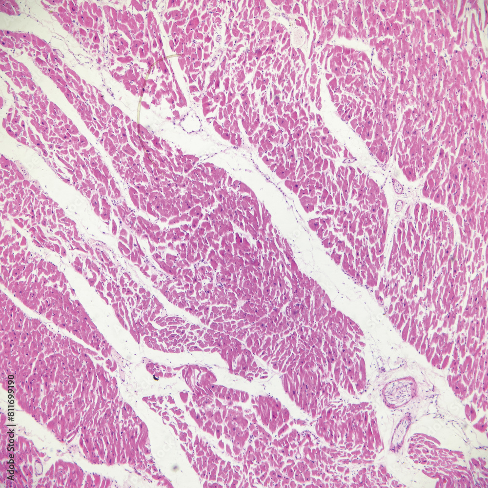 This is a pathological photo of human left ventricular hypertrophy ...