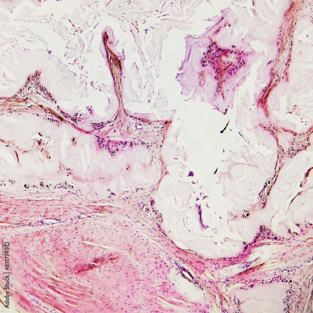 This is a pathological photo of a human gout nodule, showing the ...