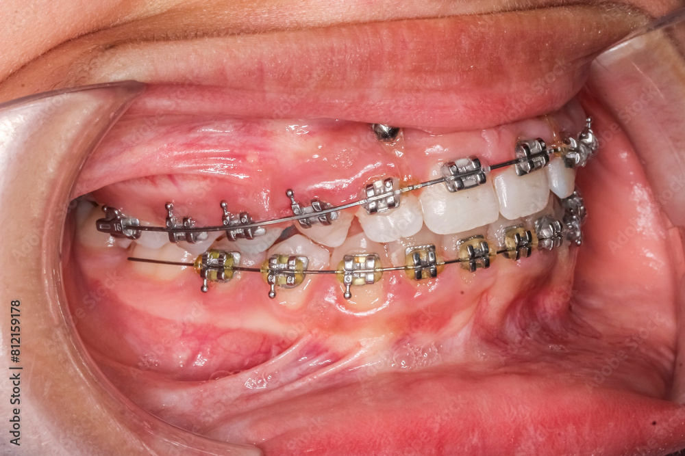 Lateral oblique view of dental arches in biting teeth occlusion ...