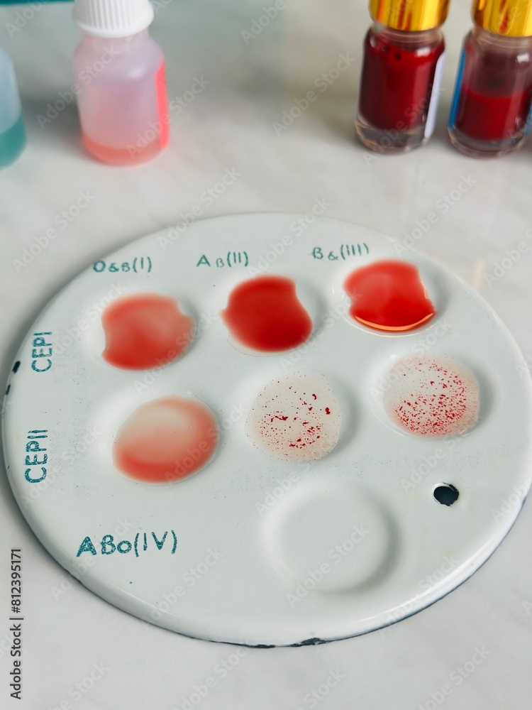 Determination of blood group according to the ABO system on a tablet ...