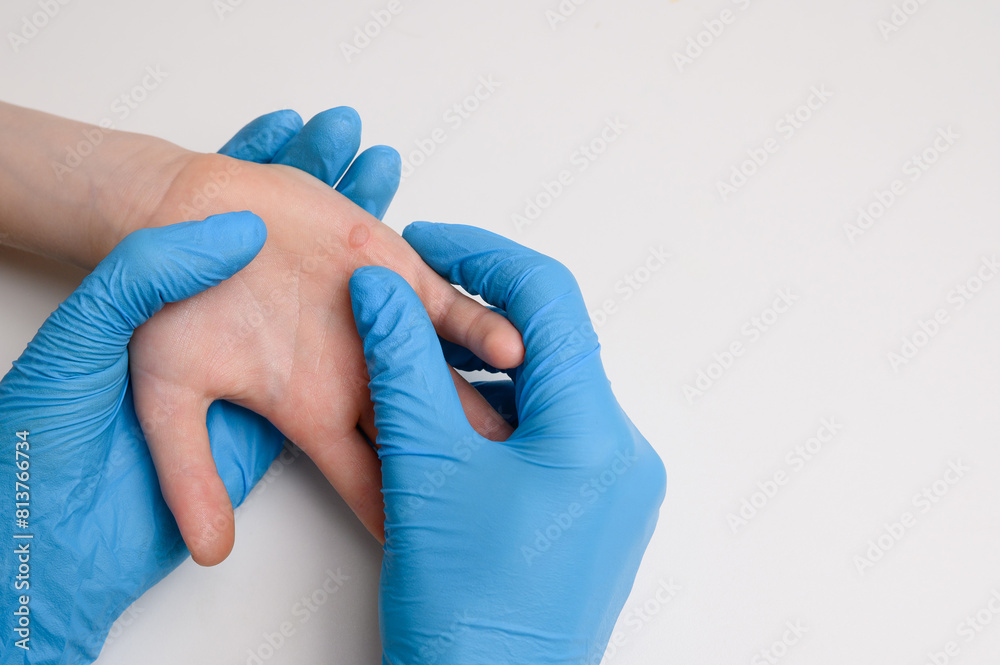 Dermatologist looks at child hand with viral flat warts, Verruca ...