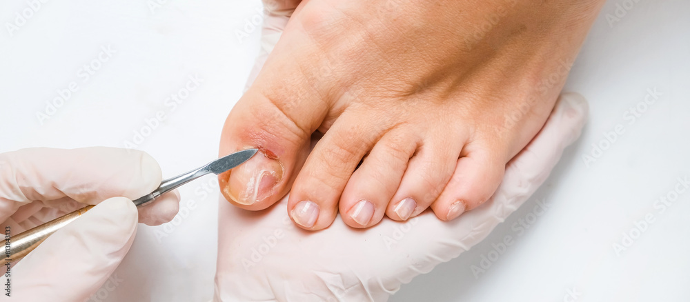 Pedicure, podologist. Patient on medical pedicure procedure, nail ...