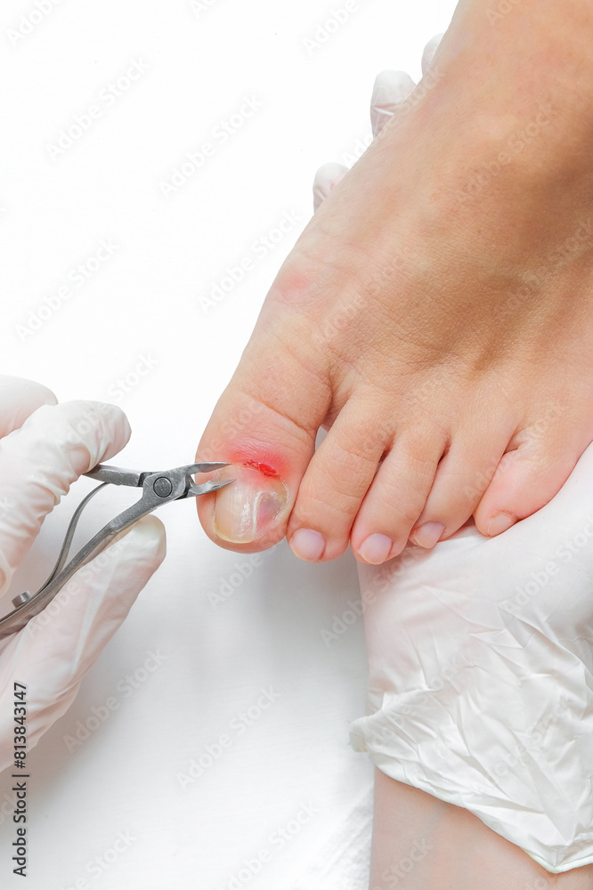 Pedicure, podologist. Patient on medical pedicure procedure, nail ...