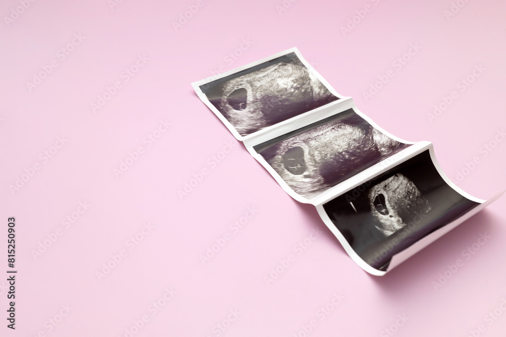 Ultrasound Image, Picture Of 7 Weeks Pregnant Woman With Twins, Embryo ...