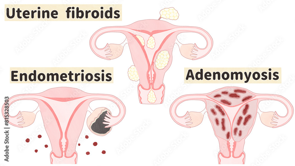 Uterine fibroids, Endometriosis and Adenomyosis; Labeled diagram PNG ...