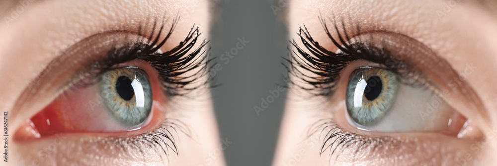 Before and after conjunctivitis treatment. Photos of woman with red and ...