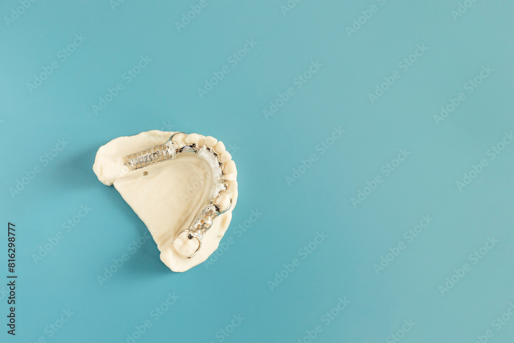 Mockup Metal Frame Lower Partial Denture, Plate On Die Stone, Plaster ...