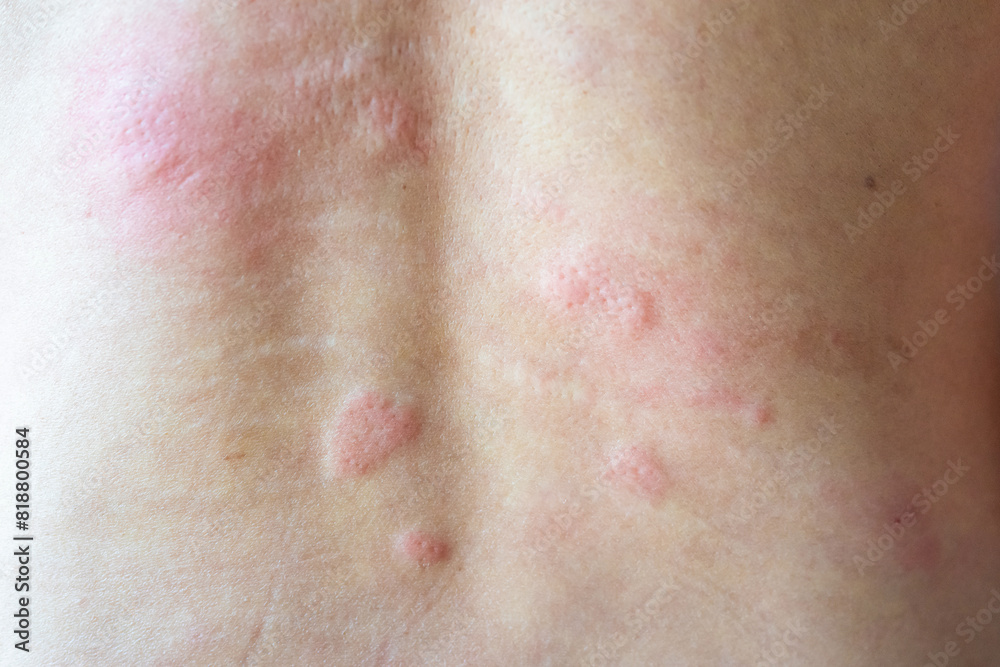 Young asian man itching and scratching on his back from allergic itchy ...