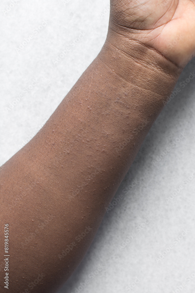 Heat rash on brown skin, prickly heat rash on dark skin, Miliaria on ...