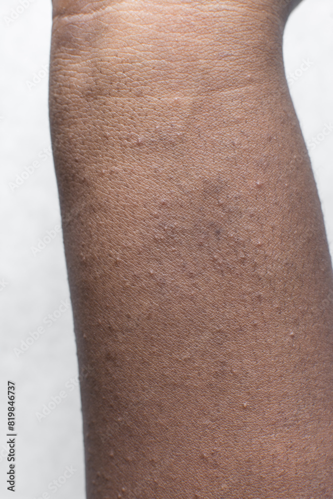 Heat rash on brown skin, prickly heat rash on dark skin, Miliaria on ...