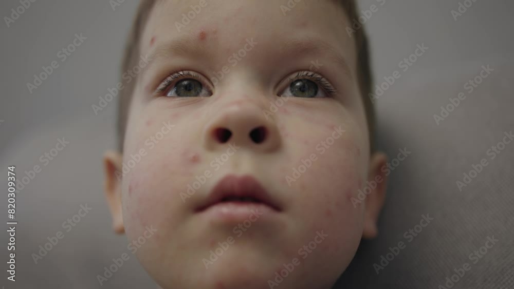Chilld boy face marked with red spots from chickenpox in close-up ...
