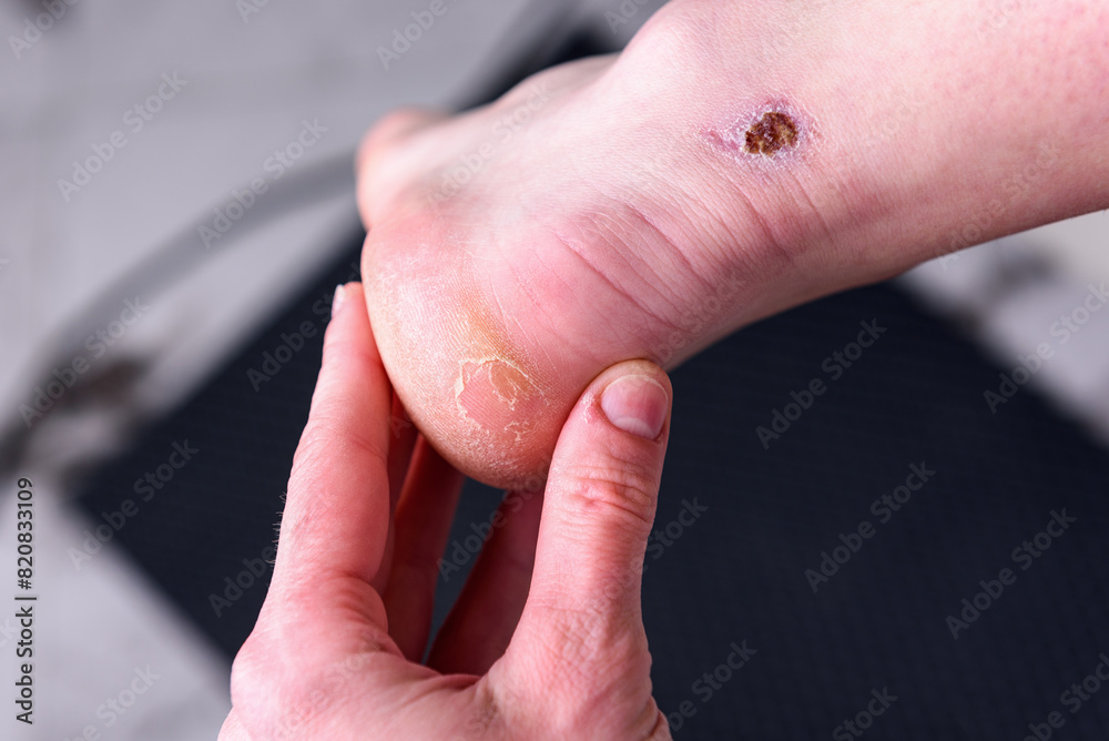 Blister and painful dryness of the skin on the heel of a barefoot woman ...