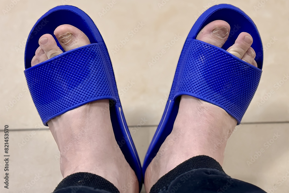 Fungal onychosis is an infection of the toenails of unknown person in a ...