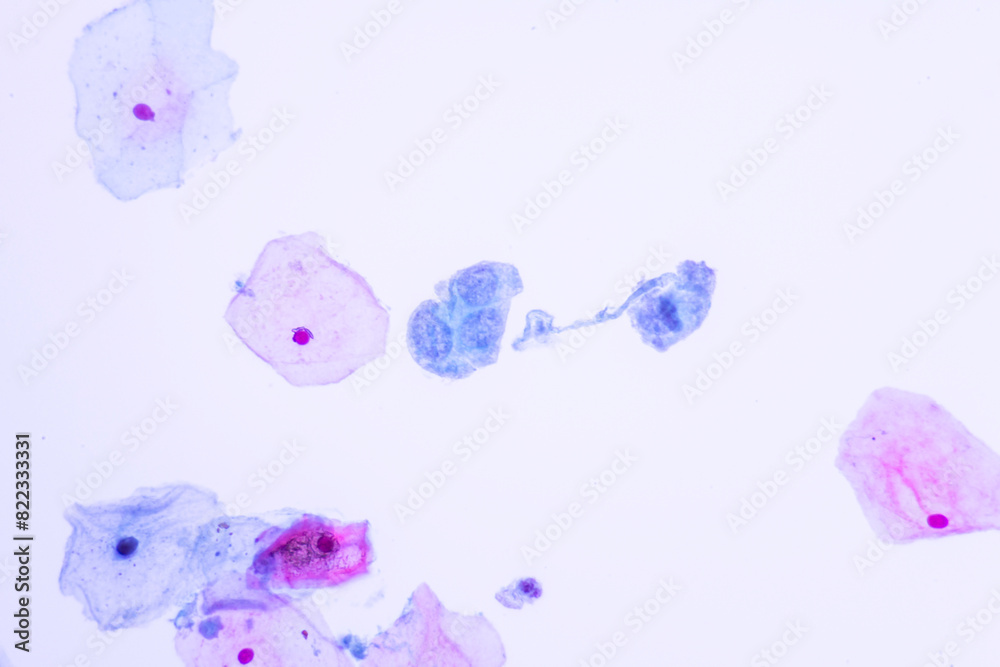 Abnormal squamous epithelial cells view in microscopy.Low grade SIL ...