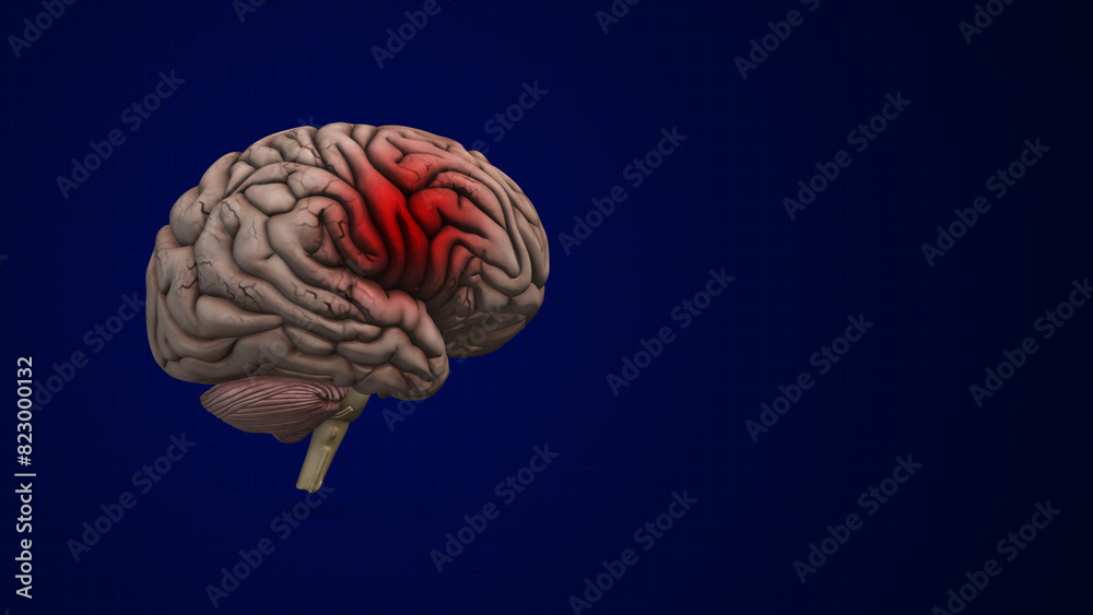 Brain bleed or an intracranial Hemorrhage Stock Illustration | Adobe Stock
