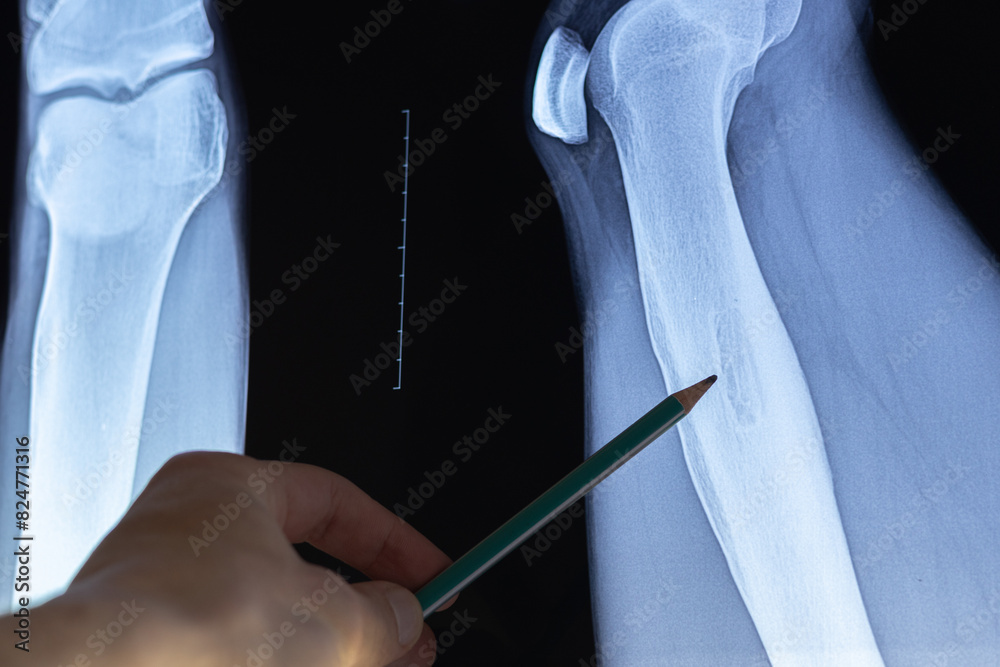 Doctor examining osteoid osteoma, benign bone tumor. X-ray and MRI, MRT ...