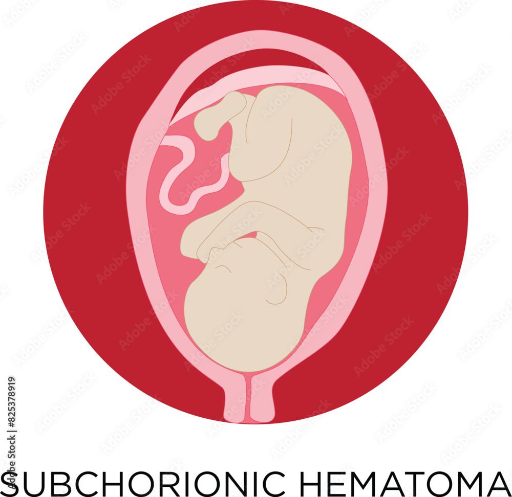 Vector medical illustration of subchorionic hematoma with blood pooling ...