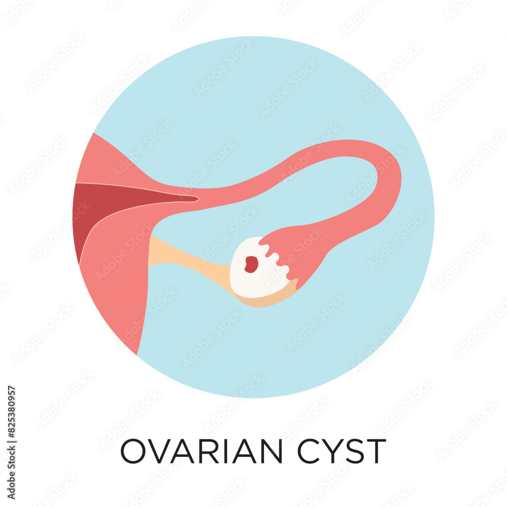 Ovarian cyst flat style vector illustration in circle layout with type ...