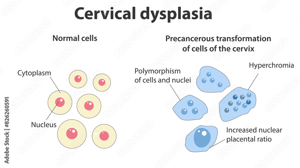 Cervical Dysplasia Normal Squamous Epithelial Cells And Atypical